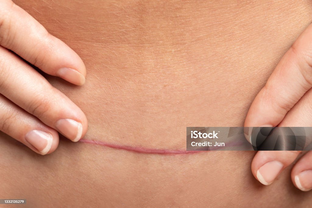Targeted Skin Needling - for Body – The Skin Boutique